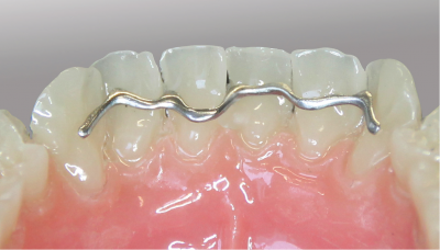 Retention nach der Clear Aligner Therapie nach KFO Behandlung | OX.Academy